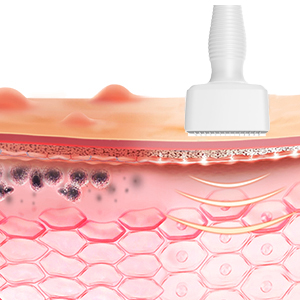 Adjustable 100 Microneedling Facial Stamp, Derma Microneedle Pen for ...